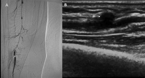 Severe Vasospasm Of The Right Radial Artery In This Case