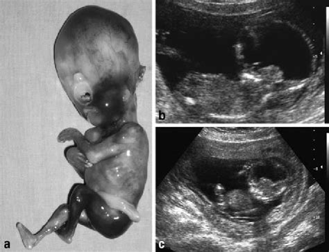 A Gross Picture Of The Fetus Showing Facial Dysmorphism Small Mouth