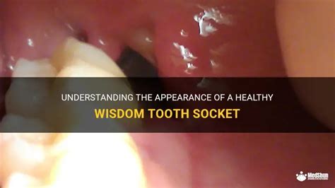 Understanding The Appearance Of A Healthy Wisdom Tooth Socket MedShun