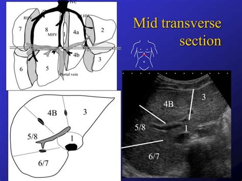 Liver Segments On Ultrasound Pptx