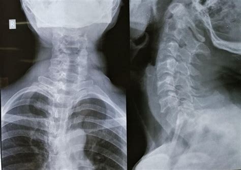 Cervical Spine X Ray Anteroposterior Ap Projection Showing An Oblique Download Scientific
