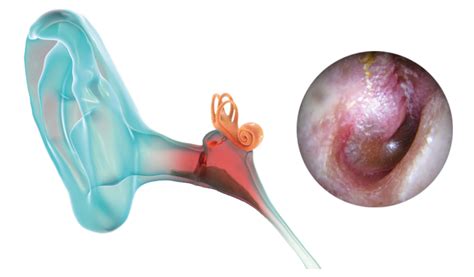 Serous Otitis Treatment Op Dr İbrahim Hira