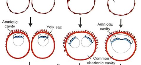 Identical Twins I E Monozygotic Pregnancy Healthy Food Near Me