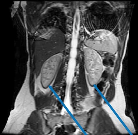Understanding Motion Artifact And Metal Artifact Mri In Imaging