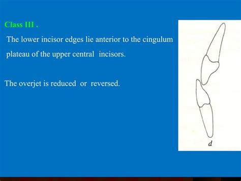 Classification Of Normal Occlusion And Malocclusion Ppt Dental