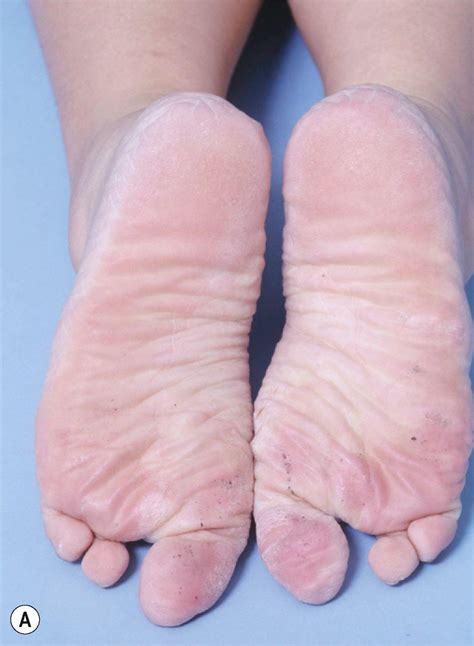 Thumb Reconstruction Microsurgical Techniques Clinical Tree