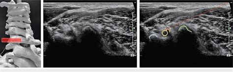 Ultrasonography Guided Selective Nerve Root Block Target C6 Nerve Ultrasonography Guided Selective Nerve Root Block Target C6 Nerve