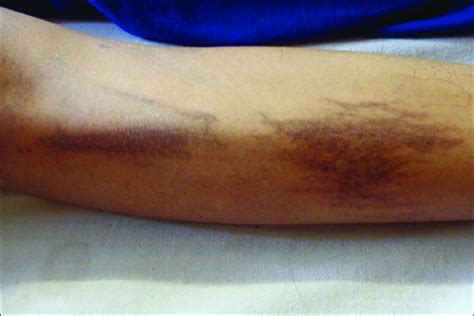 Flagellate Dermatosis By Bleomycin Download Scientific Diagram