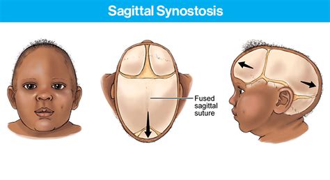 Sagittal Craniosynostosis Adults