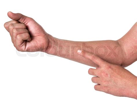 Close Up Human Skin With Red Rashes From Dengue Disease Colourbox