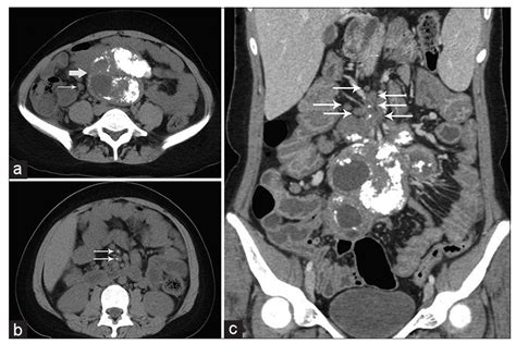 Calcification Of Lymph Nodes