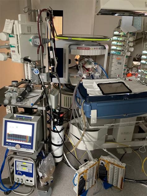 A Neonate Receiving Ecmo Thera [image] Eurekalert Science News Releases