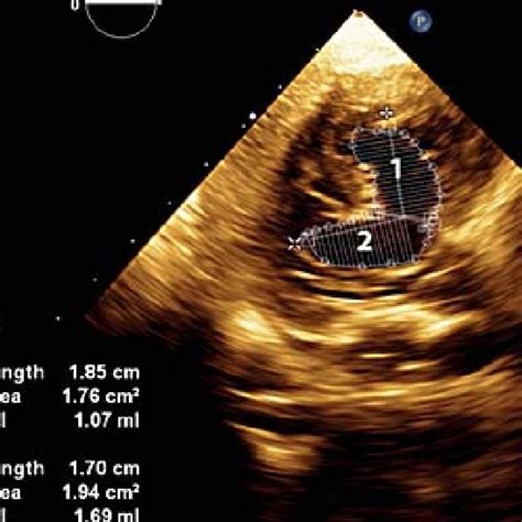 M Mode Measurement Of The Diastolic Dimensions Of Lv And Rv From Download Scientific Diagram