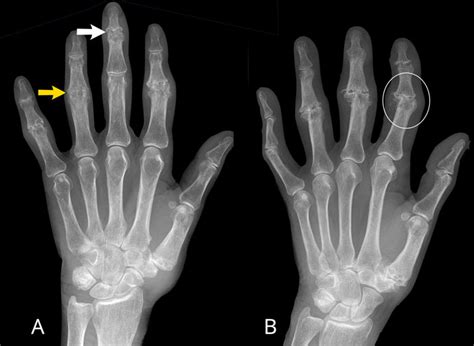 The Radiology Assistant Arthritis