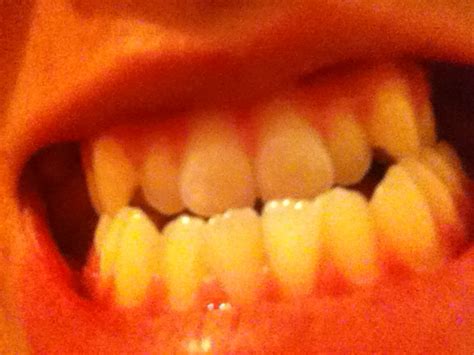 Class Iii Underbite Progress