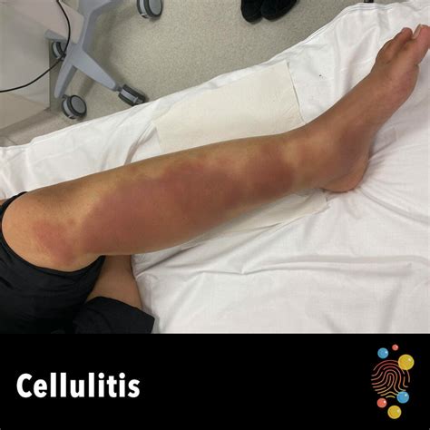 Cellulitis Skin Deep
