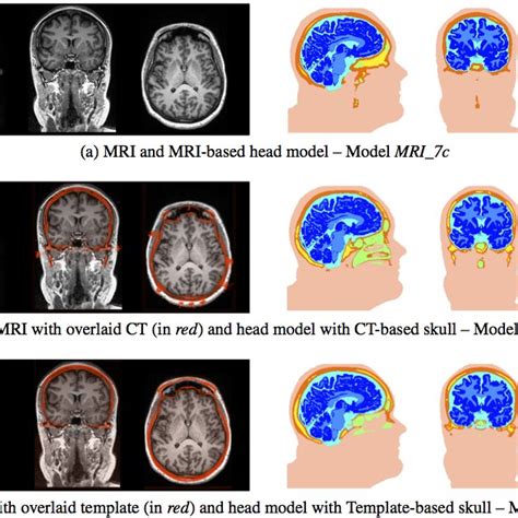 Pdf The Role Of Skull Modeling In Eeg Source Imaging For Patients With Refractory Temporal
