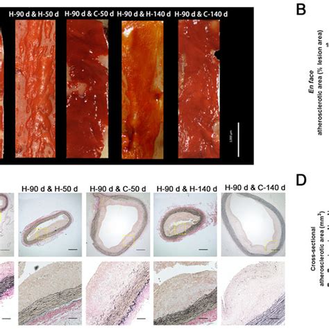 Atherosclerotic Lesion Areas Did Not Shrink After Withdrawing The Download Scientific Diagram