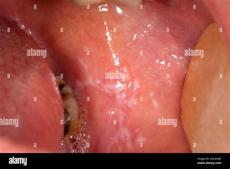 White Spots Inside Lips White Bumps On Lips Types Causes Symptoms White Spots Inside Lips White Bumps On Lips Types Causes Symptoms