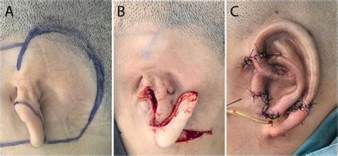 A Modified Two Stage Ear Reconstruction With Integrated Correction