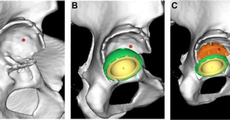 Journal Of Arthroplasty On Linkedin Compared With 2d Templating 3d Simulation Is More Accurate