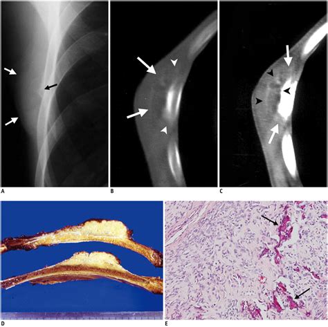 Osteogenic Sarcoma Codmans Triangle Osteogenic Sarcoma Codmans Triangle