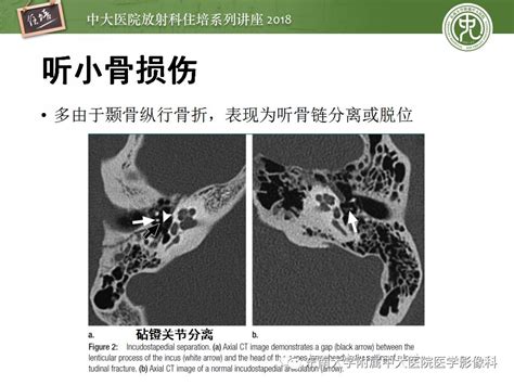 中耳解剖及中耳病变影像诊断 医学影像