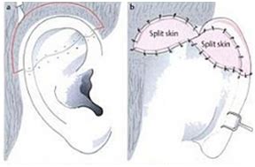 Upper Third Auricular Reconstruction Surgery Of Cauliflower Ear