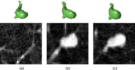 Figure 1 From Automated Pulmonary Nodule Detection System In Computed Tomography Images A