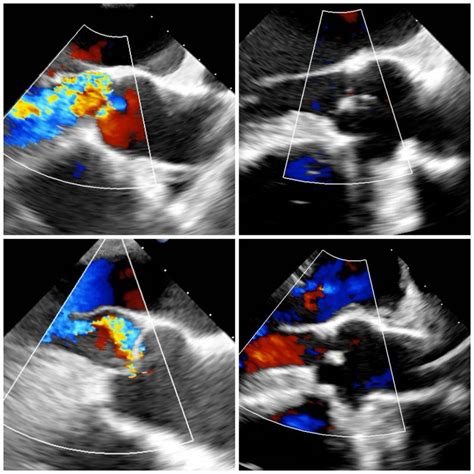 Repair Of Aortic Valve Insufficiency Has Many Advantages Over Valve