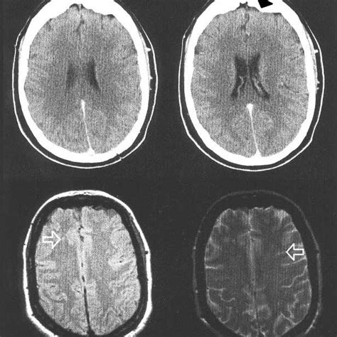 A B Two 7 Mm Axial Cranial Ct Scans Evidence The Bilateral Thickening Download Scientific