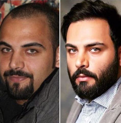 عکس‌های احسان علیخانی قبل از کاشت مو لو رفت تصاویر