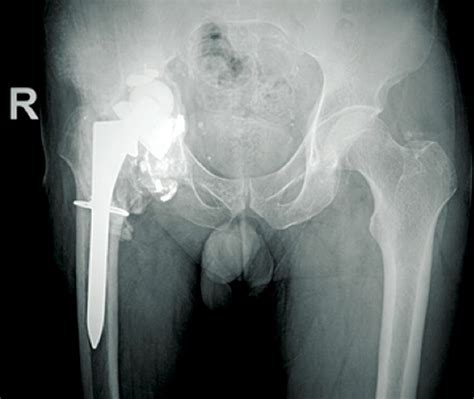 A 50 Year Old Male Patient With Untreated Acetabular Liner Fracture On Download Scientific