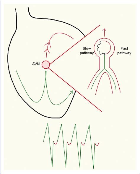 Diagram Of An Av Nodal Reentrant Supraventricular Tachycardia In Which Download Scientific