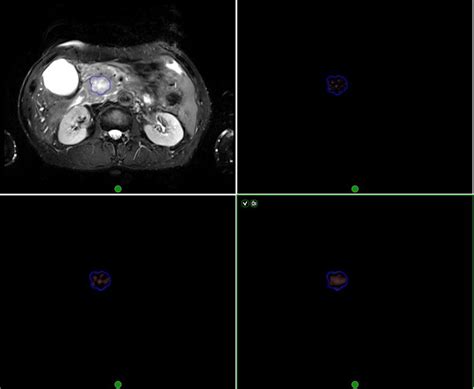 An Example Of Texture Analysis Of Pancreatic Ductal Adenocarcinoma Download Scientific Diagram
