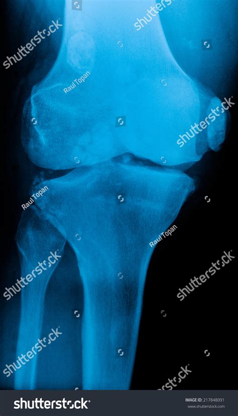 Oblique Knee X Ray Labeled At Dorothy Lim Blog