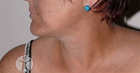 Diffuse Melanosis Cutis Image