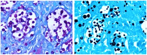 Photomicrograph Of Lymph Node Biopsy Showing Variably Sized Budding