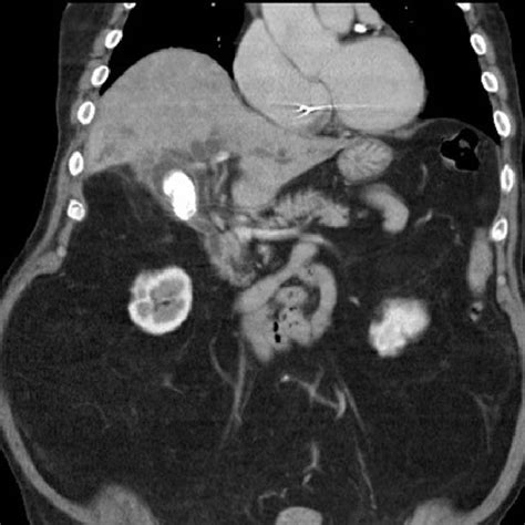 Cholangiogram Demonstrating Filling Defects At The Common Hepatic Duct