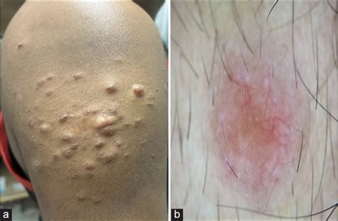 Cutaneous Leiomyomas Indian Journal Of Postgraduate Dermatology