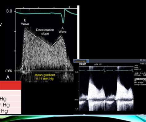 Mitral Stenosis Flashcards Quizlet