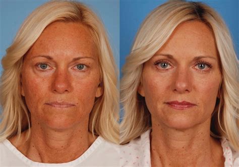 Lower Blepharoplasty Gone Wrong Photos The Reality Of Eyelid Surgery
