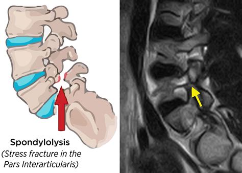 Spondylosis Definition Causes Symptoms Diagnosis Treatment