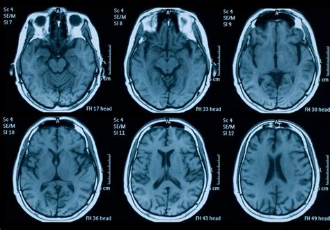Denoising Ai Model For Accelerated Parallel Brain Mri
