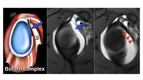 Radiological Anatomy Of Shoulder Joints Pptx