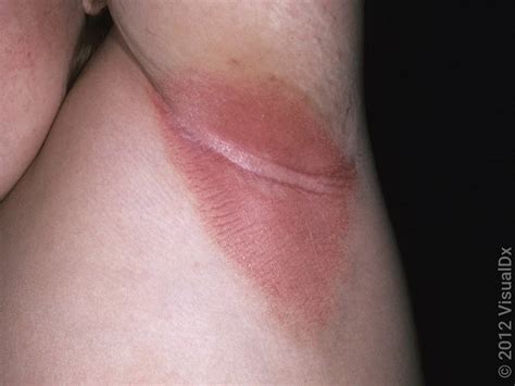 Heres What Psoriasis Looks Like Around The Body With Pictures Goodrx