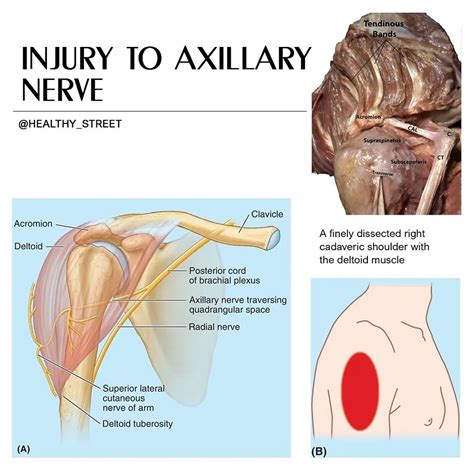 Healthy Street 🔈 Injury To Axillary Nerve The Deltoid Facebook