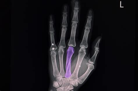 Premium Photo Xray Film Of Spiral Fracture Of Third Metacarpal Bone With Metallic Artifacts