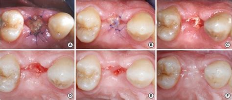 Healing Stages Of A Normal Socket After Tooth Extraction A Complete