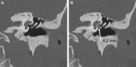 Preoperative High Resolution CT Scan Of The Temporal Bone A Download Scientific Diagram